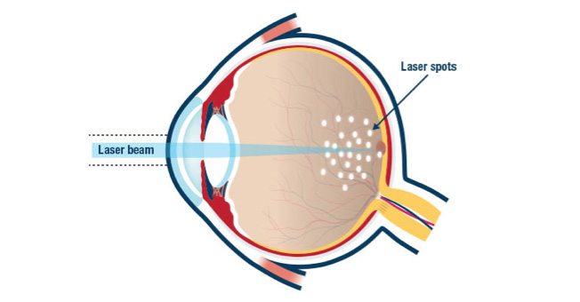Retinal Services and Surgery - plessenophthalmology.com