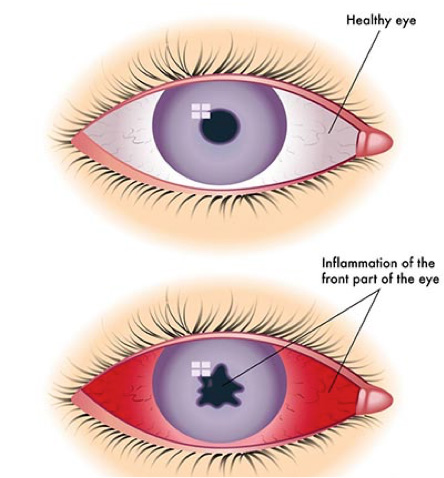 Uveitis - plessenophthalmology.com